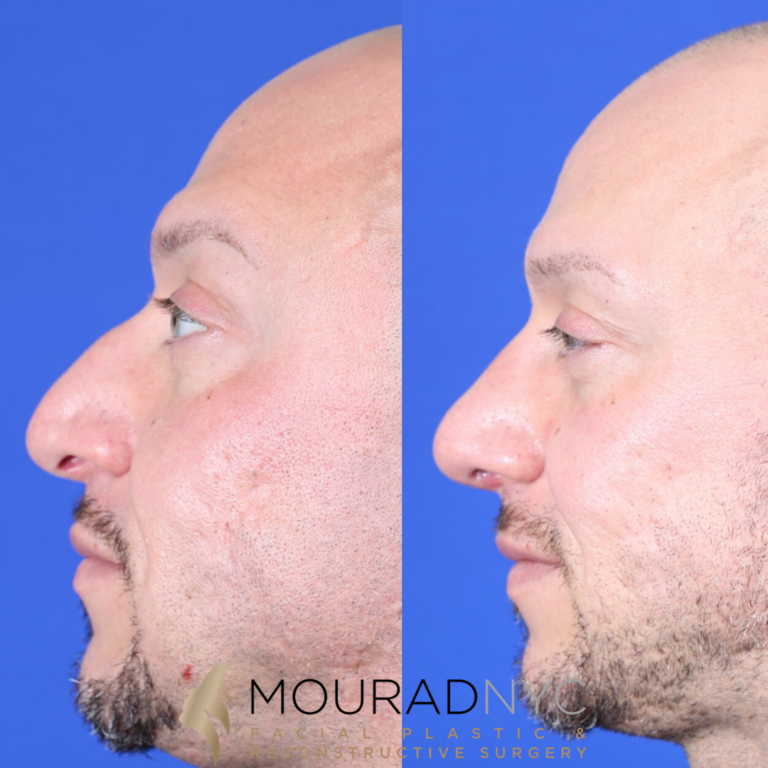Male Deviated Septum / Rhinoplasty Before and After - Head and Neck Surgeon