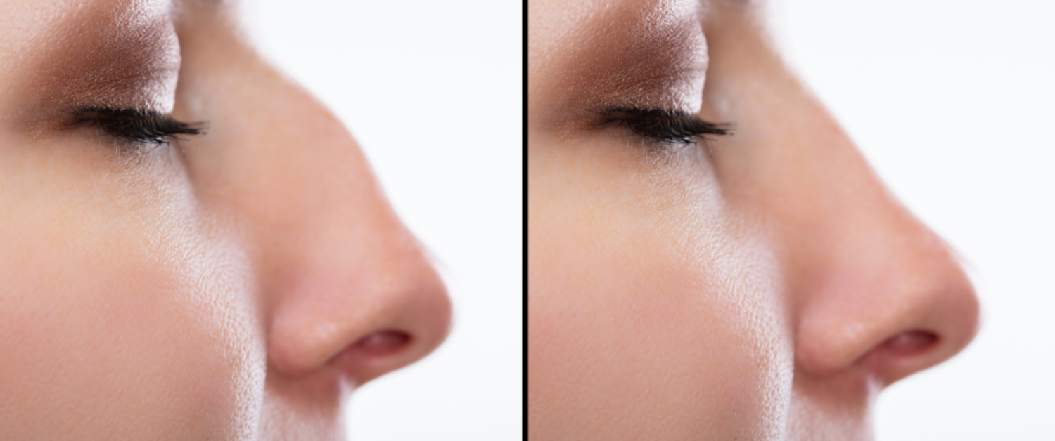 Pollybeak Deformity | Facial Plastic Surgeon